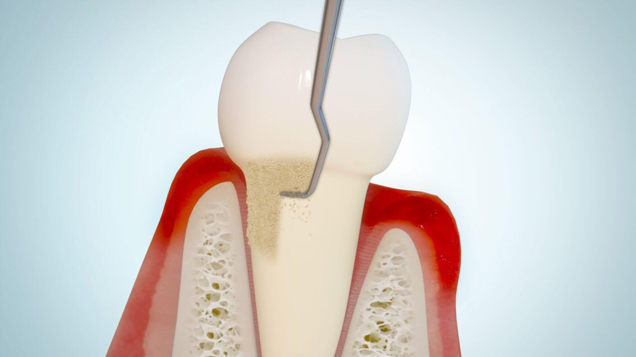 Parodontitis: Ursachen und Symptome - Happydens